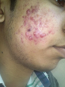 Gambar Jerawat - Alodokter