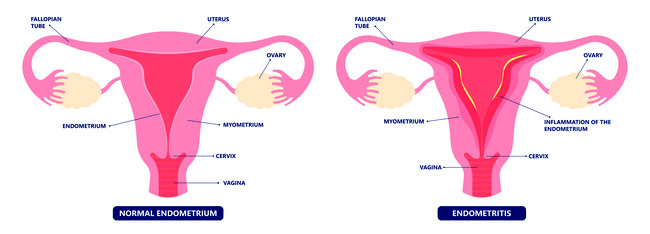Endometritis - Gejala, penyebab dan mengobati - Alodokter